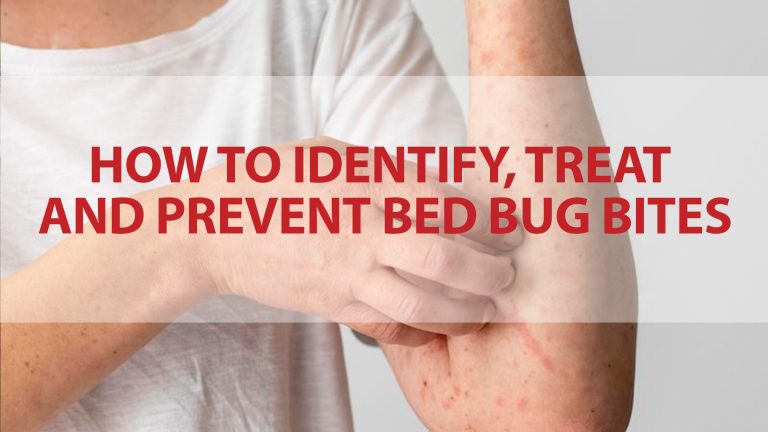 How to Identify, Treat and Prevent Bed Bug Bites